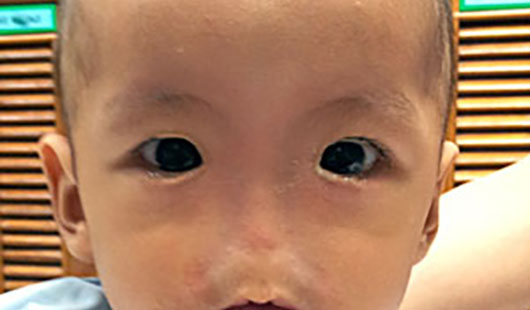 Mutation found in patients without a nose - A*STAR Research